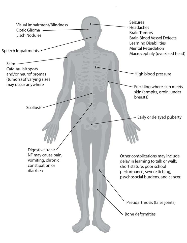 What is NF - Neurofibromatosis Network