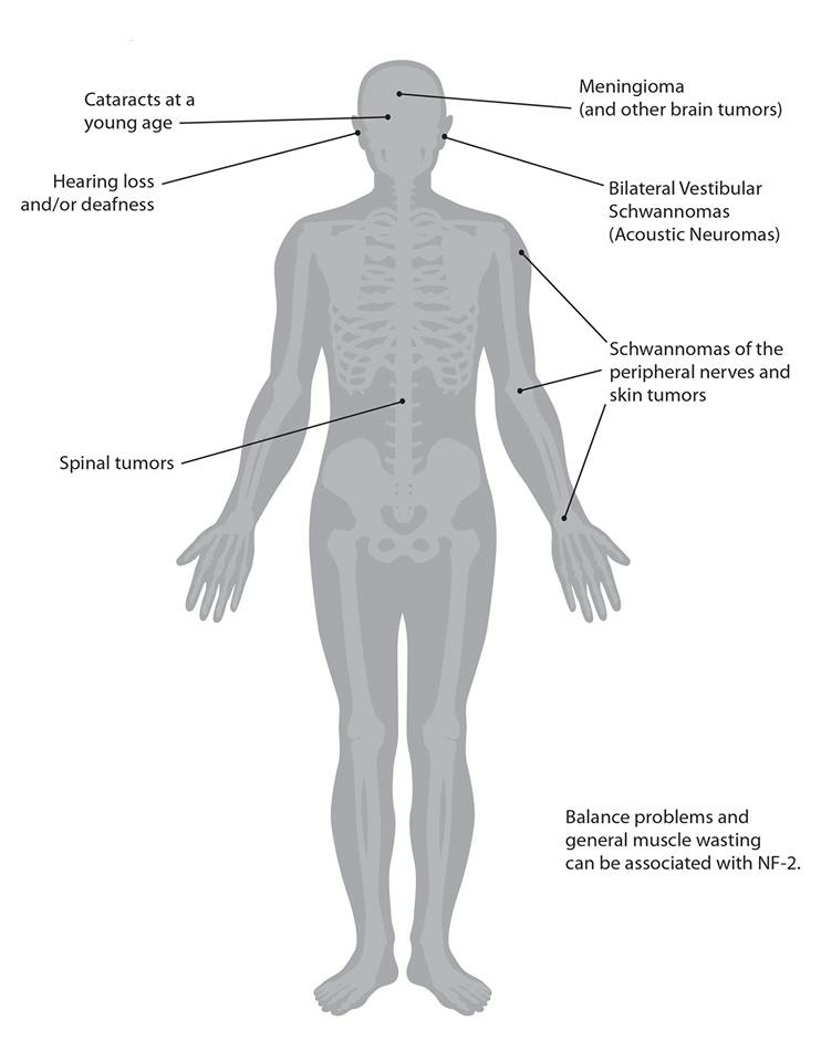 What is NF - Neurofibromatosis Network
